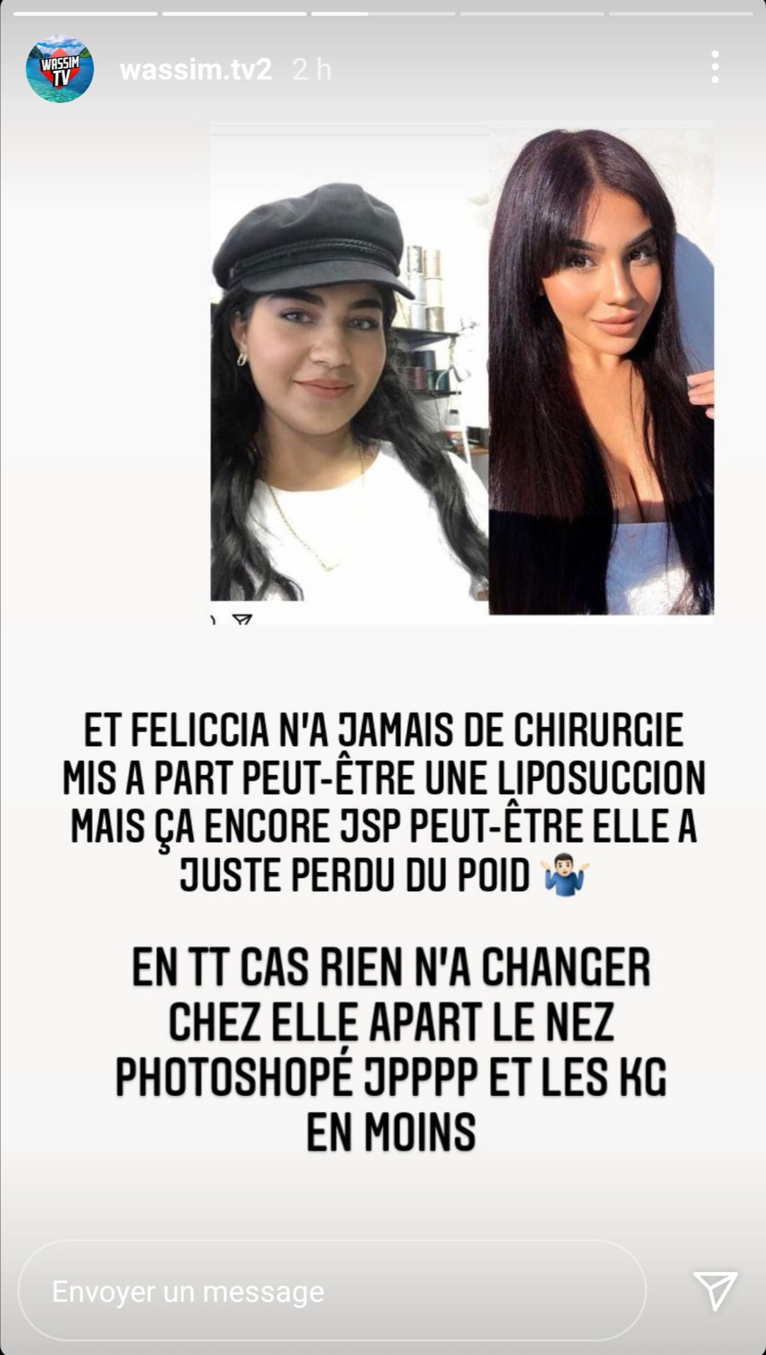 Feliccia (LPDLA8) a-t-elle eu recours à la chirurgie esthétique ? Une ...