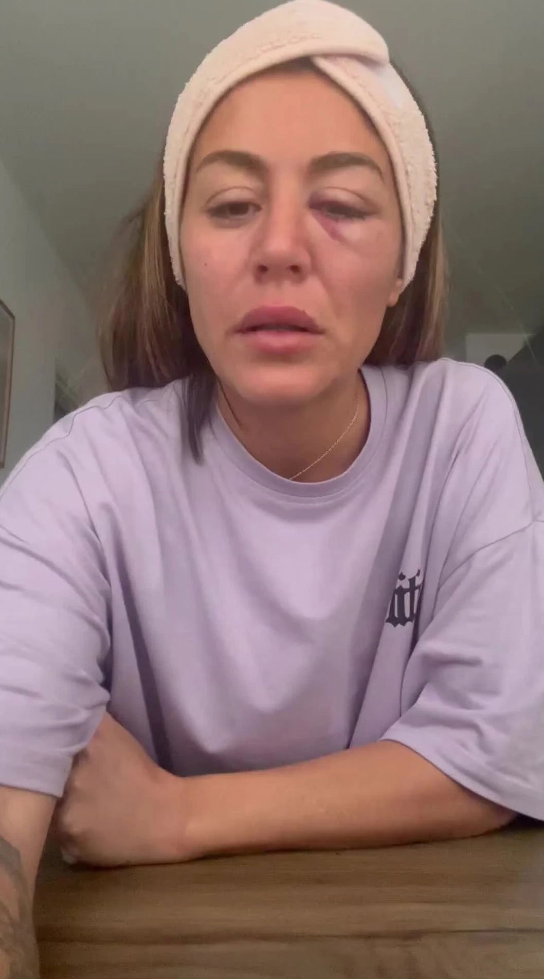 Anaïs Camizuli défigurée après avoir été agressée par un inconnu : "C ...