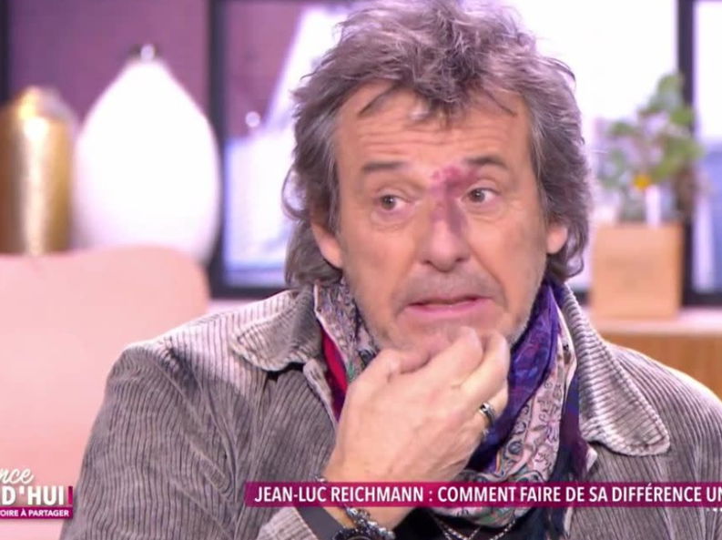 Jean-Luc Reichmann sur les remarques sur son angiome au visage : "On m ...